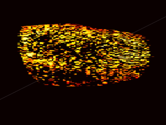 A world-first: Assessing the quality of kidneys before transplantation ...